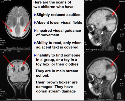Impairment of vision due to damage to the brain